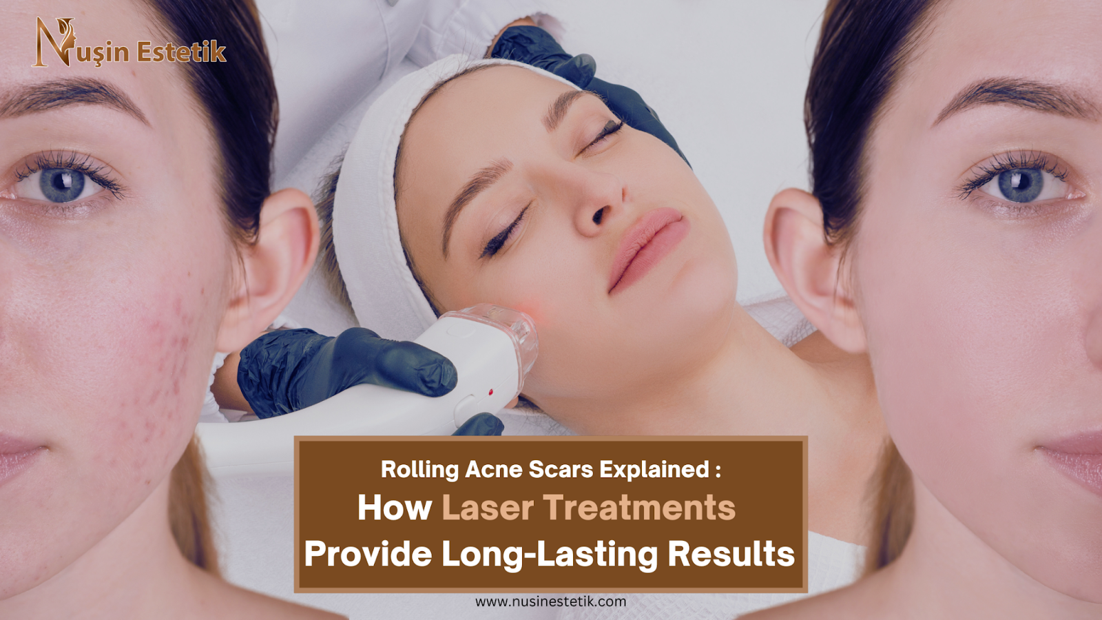 Rolling Acne Scars Explained: How Laser Treatments Provide Long-Lasting ...